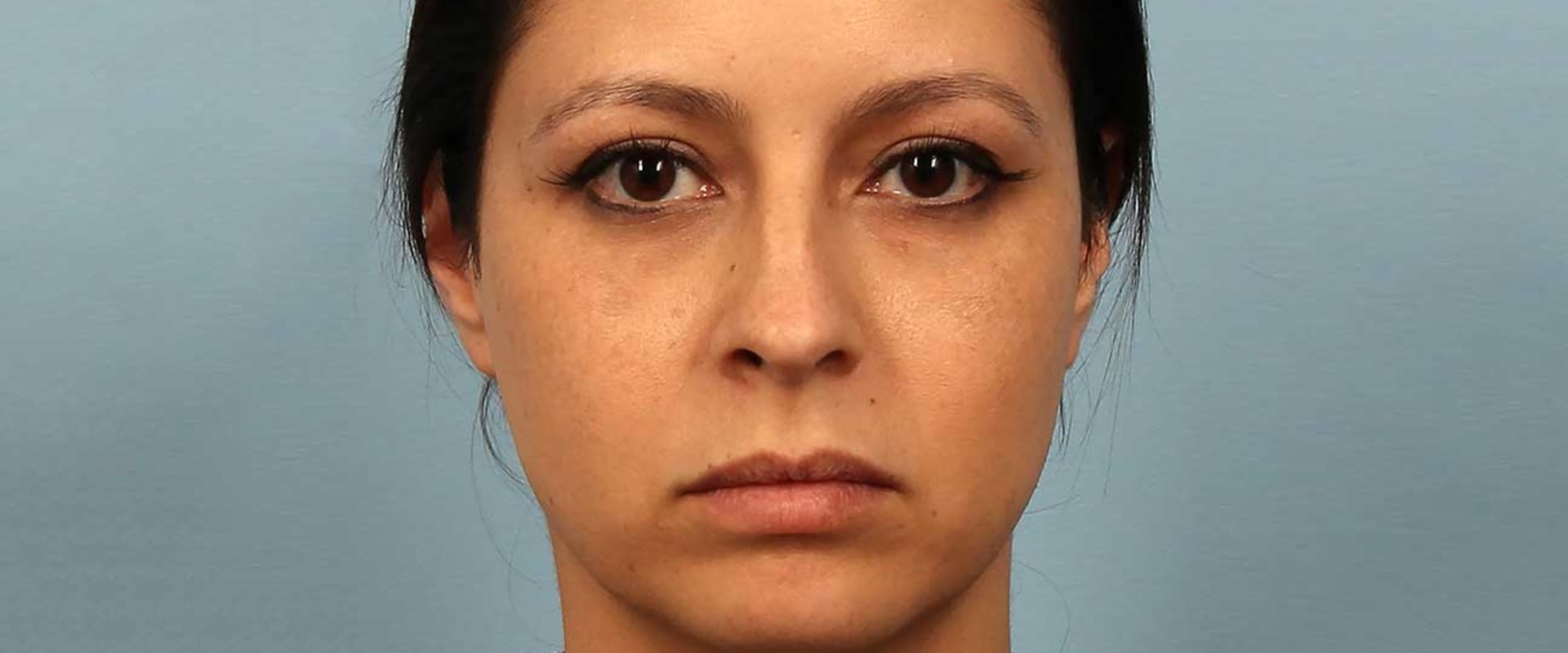 How Long Does Botox and Restylane Last? A Comprehensive Guide